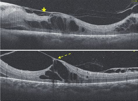 The Oct Image Of The Left Eye Fundus Photograph In Figure 4 Tangential