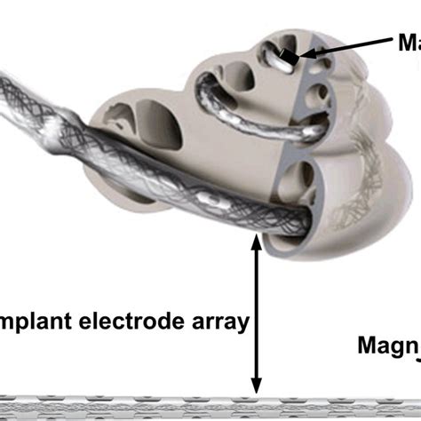 Cutaway View Of A Cochlea With An Inserted Electrode Array Photo By