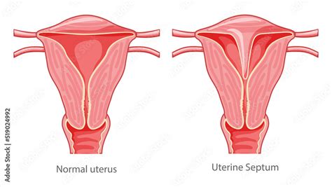 Set Of Uterine Septum Septate Uterus Female Reproductive System Diagram