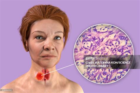 Woman With Thyroid Cancer Illustration High Res Vector Graphic Getty