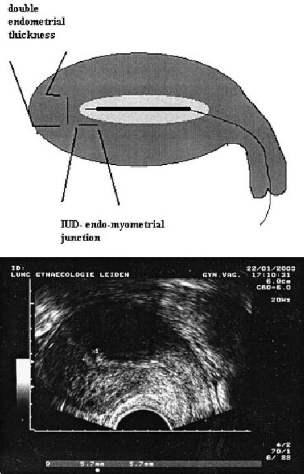 A Systematic Representation And Transvaginal Scan Displaying The Download Scientific Diagram