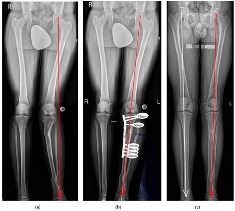 Corrective Osteotomies In Severe Non Idiopathic Lower Limb Alignment