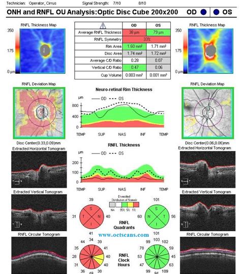 Central Retinal Artery Occlusion Crao Optical Coherence Tomography