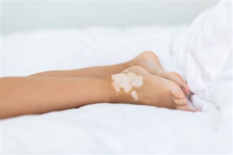 Apendicitas Simptomai Priežastys Skausmo Vieta