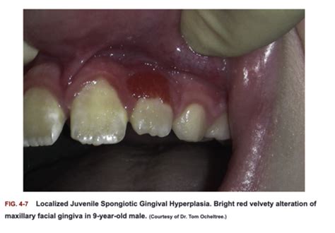 Case 9 Localized Juvenile Spongiotic Gingival Hyperplasia Flashcards