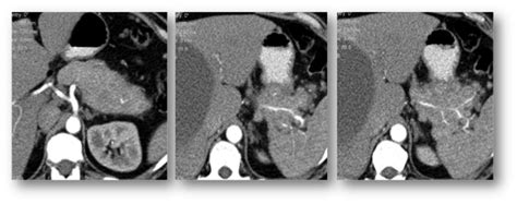 Nonfunctioning Pancreatic Neuroendocrine Tumors Axial Ct Images