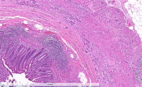 Week 751 Case 3 Johns Hopkins Surgical Pathology Unknown Conference