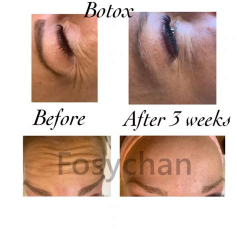 Btx Injection Botulinum Toxin Face Lift Powder Injection