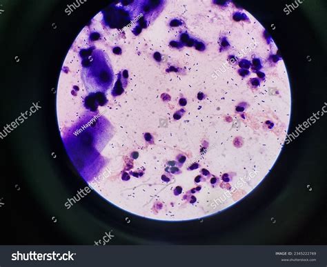 Gram Positive Diplococci Lancet Shaped Evaluating Sputum And Pleural