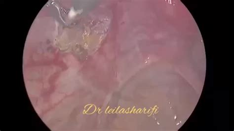 Leila Sharifi On Linkedin Laparascopy Removal Endometriosis