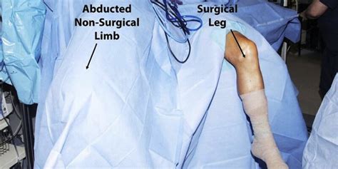 The Surgical Limb Is Placed In A Leg Holder Whereas The Nonoperative