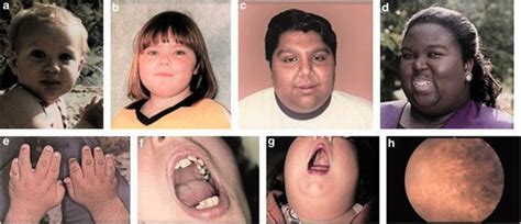Bardet Biedl Syndrome Medlineplus Genetics