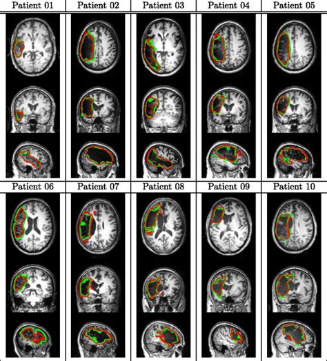 Sample Results Of Lesion Detection On Selected 2d Slices Of Different