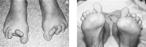 Figure 13 From Predislocation Syndrome Progressive Subluxation