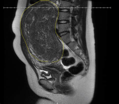 Eviction Day Happened Robotic Myomectomy And Im Walking Around Pretty
