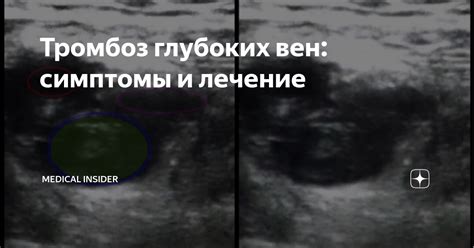 Тромбоз глубоких вен симптомы и лечение Мedical Insider Дзен