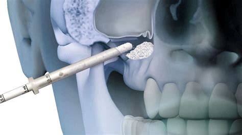 Bone Grafting And Sinus Lifts Dentart Implant And Esthetic Dentistry