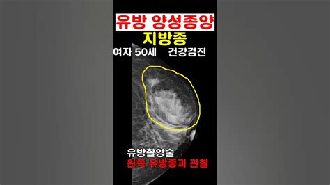 유방양성종양 지방종 유방촬영술 유방초음파 진단 Youtube