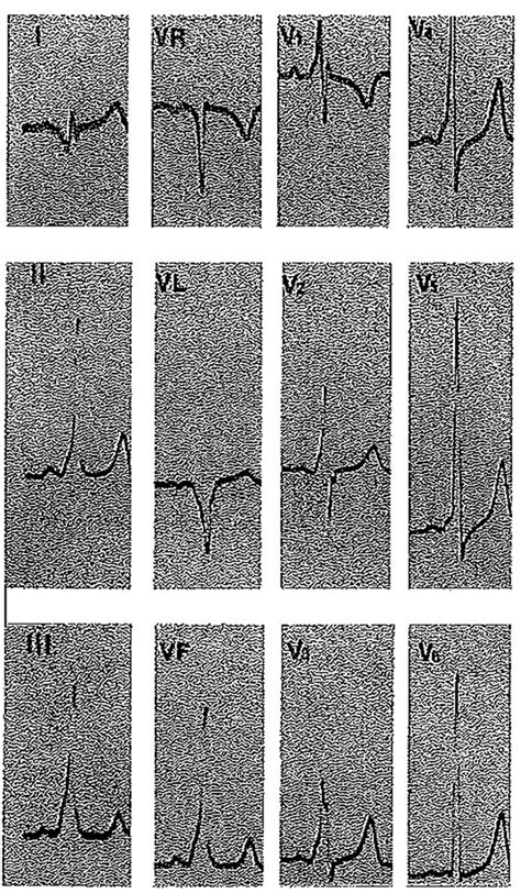 Differential Diagnosis Of Rsr Pattern In Leads V1‐v2 Comprehensive