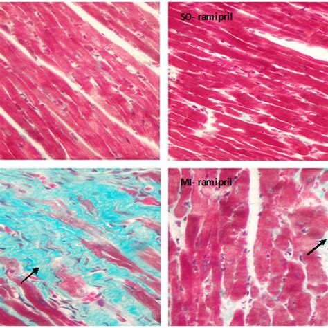 Myocaridal Fibrosis After Myocardial Infarction Detected By Massons Download Scientific