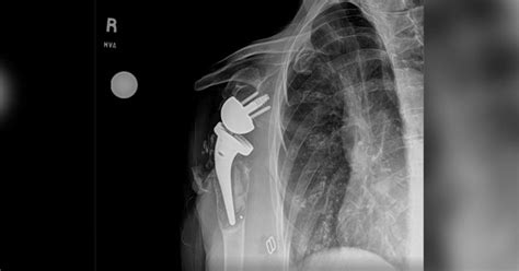 Allograft Prosthetic Composite Rsa Surgery Uses Telescope And Flange Techniques