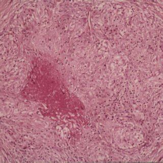 PDF Mycobacterium Marinum