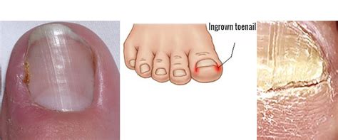 Softening Toenails For Cutting Nail Ftempo