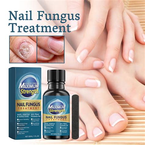 Toenail Antifungal Liquid Extra Strength Toenail Fungus Treatment 1
