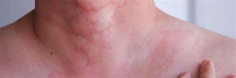 Chronic Inducible Urticaria Diagnosis Supported By Updated Algorithm Physicians Weekly