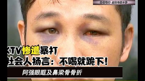 小伙参加生日宴惨遭暴打 导致眼睛成了”熊猫“ 鼻青脸肿头部骨折 Youtube