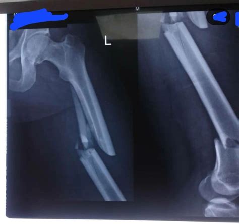 Segmental Femur Shaft Fracture 33 Year Old Male With Rta Developed Left Segmetal Fracture