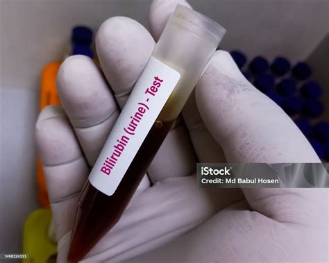 Technician Holding Urine Sample For Bilirubinuria Test Urine Bilirubin Test Urine Analysis Stock
