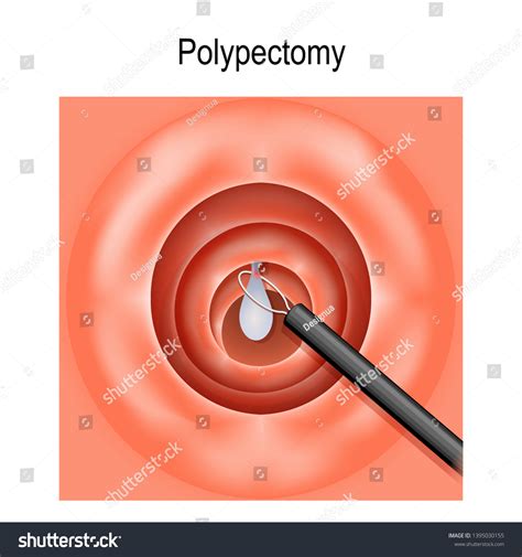 Colorectal Polyp Polypectomy Diagram Medical Biological 스톡 일러스트 1395030155 Shutterstock