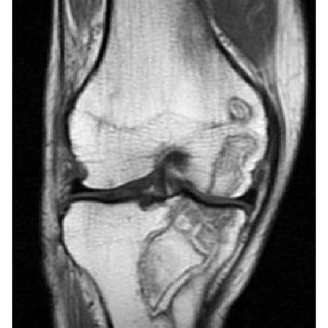 Pdf Multifocal Osteonecrosis Secondary To Chronic Alcohol Ingestion