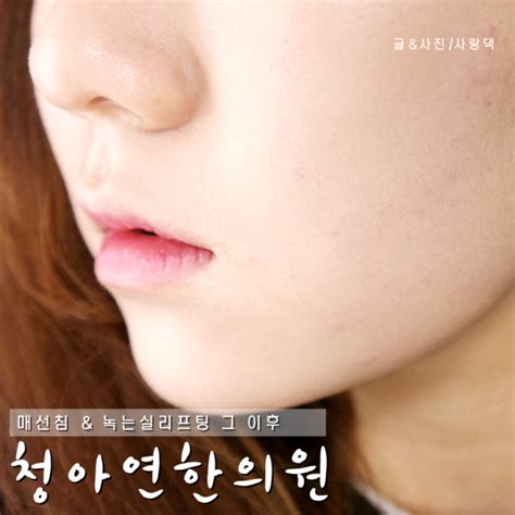 매선침 녹는실리프팅 후기 With 청아연한의원 네이버 블로그