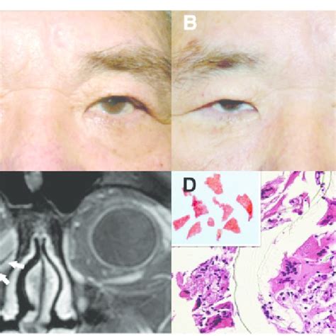 Patient 2 A A 69 Year Old Male Presented With Persistent Swelling At