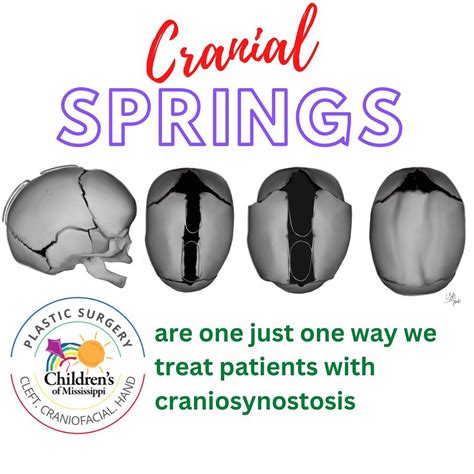 Strip Craniectomy And Cranial Expansion With Springs Is A Minimally
