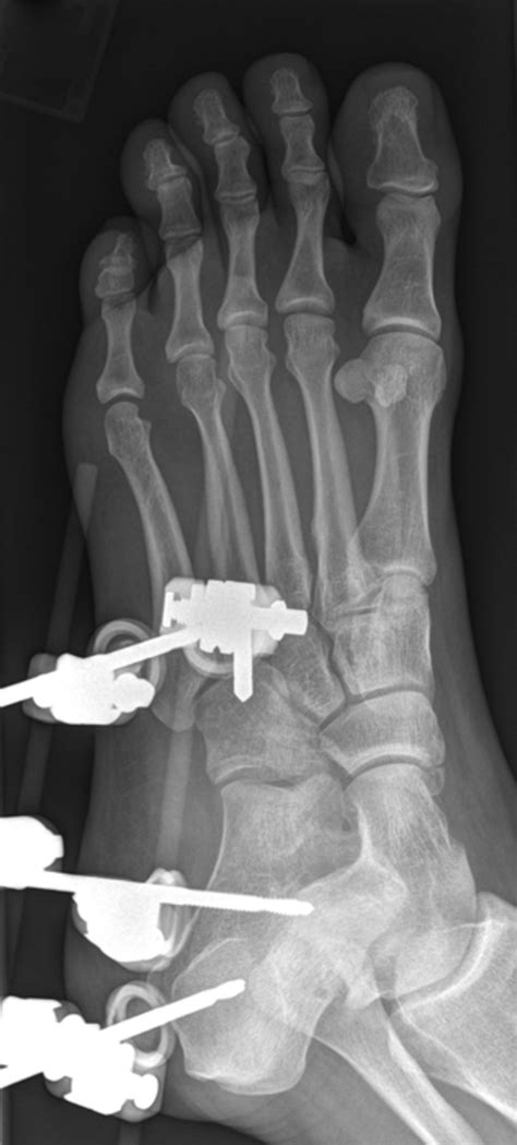 The Patterns Of Injury And Management Of Cuboid Fractures Bone And Joint