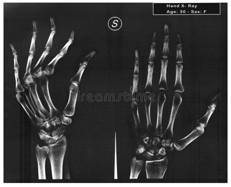 Real Radiograph Of A Woman Hand Stock Image Image Of Digital Film 365148601
