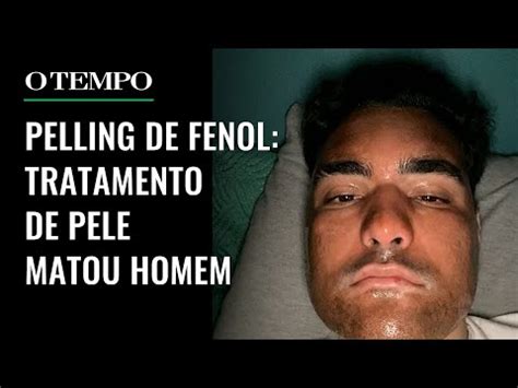 Entenda o que é peeling de fenol procedimento estético que matou jovem