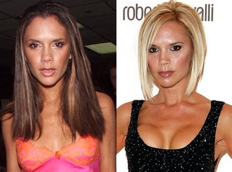 celebs con aumento de pecho Expertos en Medicina Estética