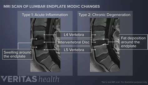 Basivertebral Nerve Ablation For Lower Back Pain En 2024