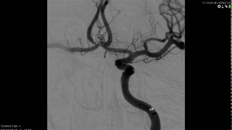 Endovascular Aneurysm Coiling And Stenting Youtube