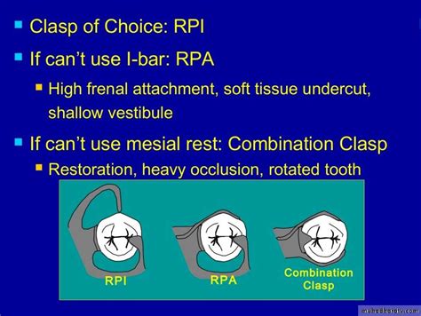 Lec 2principles And Essential Of Rpd Design Pptx د رضوان Muhadharaty