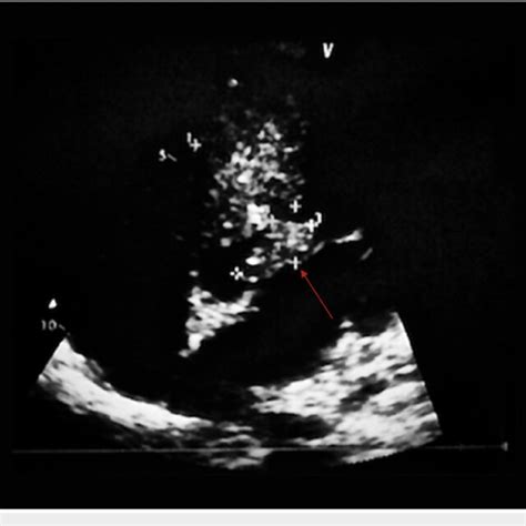 Parasternal Long Axis View On Transthoracic Echocardiogram Showing A