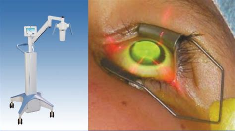 C3r Procedure In Punjab Singla Eye Hospital Punjab