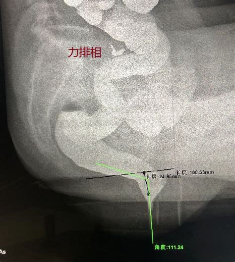 正常排粪造影图片 清肠 排便 大山谷图库
