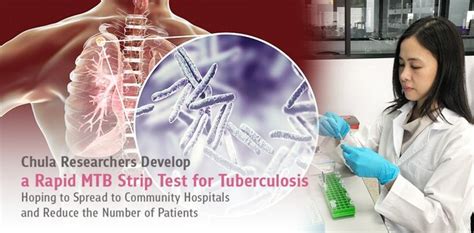 Chula Researchers Develop Rapid Mtb Strip Test For Tuberculosis Pr