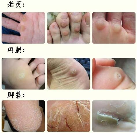 腳底厚繭、雞眼、皸裂，用了這款生物膜還你一雙美足！ 壹讀