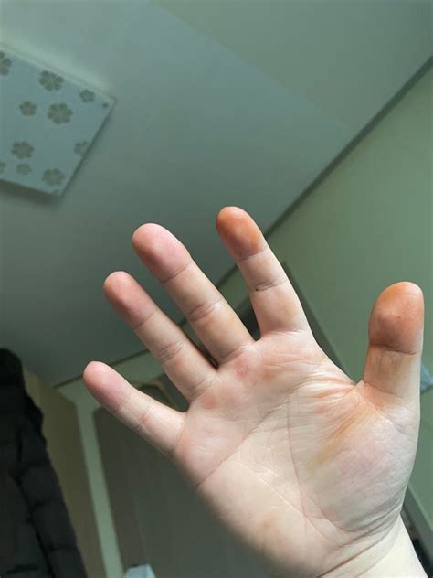 갑자기 손에 색이 들었습니다 지식in